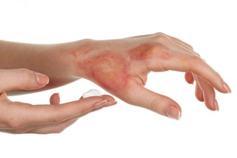 Erste Hilfe bei Verbrennungen